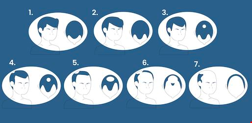 The Norwood Scale: A Guide to Male Pattern Baldness and Hair